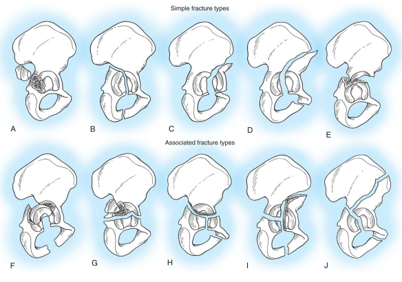11:50: Clasificación de Letournel y Judet para Fracturas Pélvicas