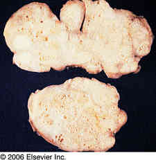 The Pathology Anatomi: Hiperplasia prostat