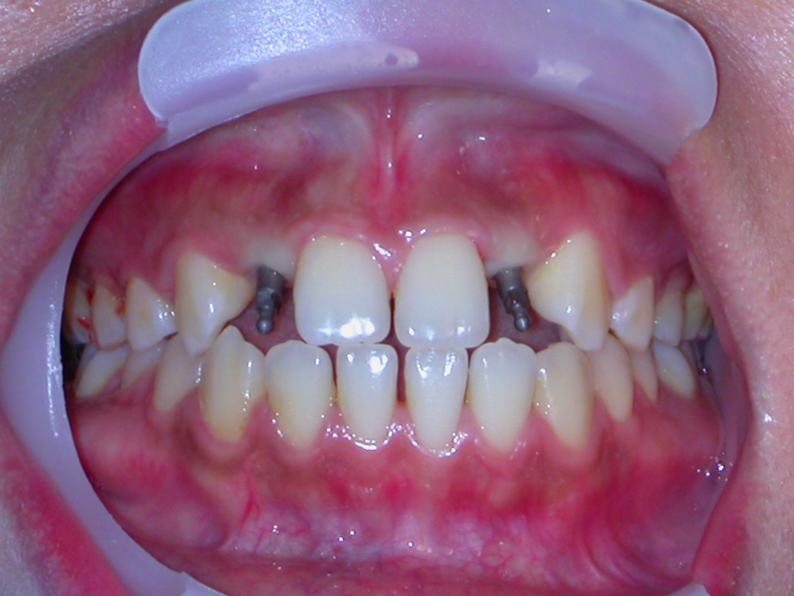Dental Implantology: MOSTDI REPLACEMENT OF MISSING UPPER LATERALS