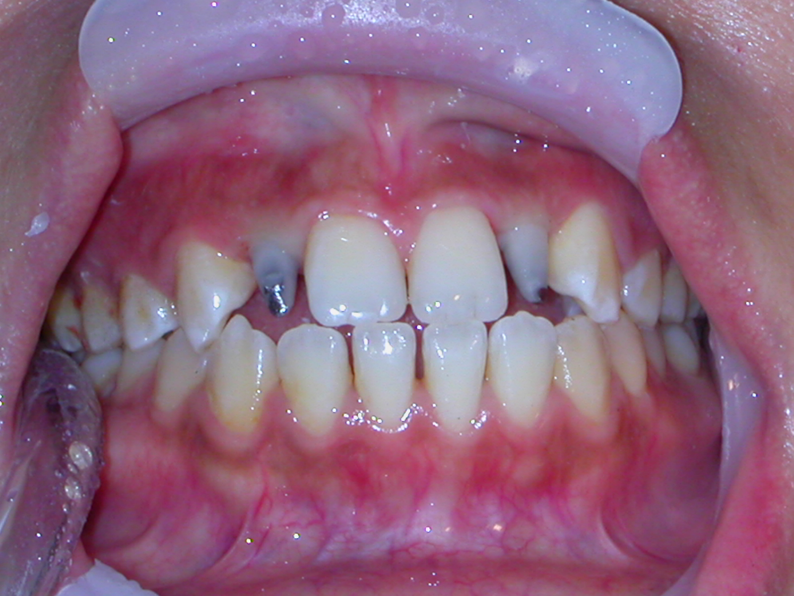 Dental Implantology: MOSTDI REPLACEMENT OF MISSING UPPER LATERALS