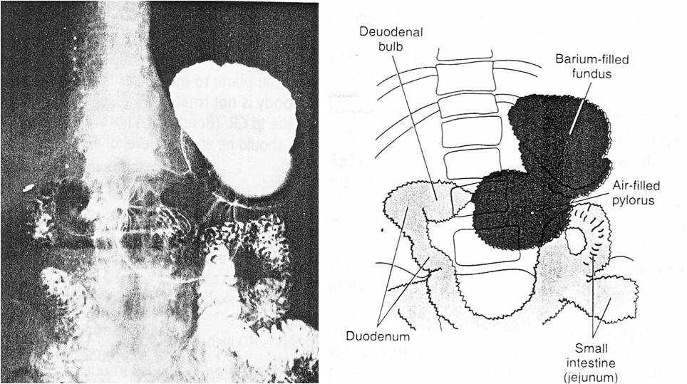 AKHSANUR BLOG'S: Teknik Radiografi OMD (Oesophagus Maag Duodenum)