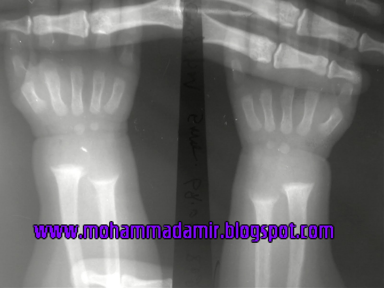 Dr. Amir's Blog: Rickets