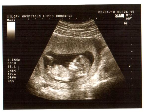 Persiapkan Pernikahan Anda: Perkembangan kehamilan baby tercinta