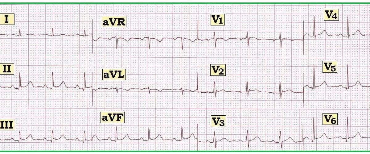 ECG Interpretation: ECG Interpretation Review #12 (Computerized ECG ...