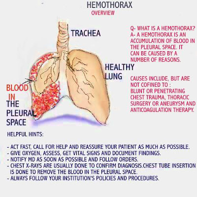 Dear Nurses: IDENTIFYING HEMOTHORAX IN THE CLINICAL SETTING