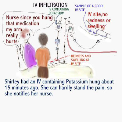 Dear Nurses: IV INFILTRATION