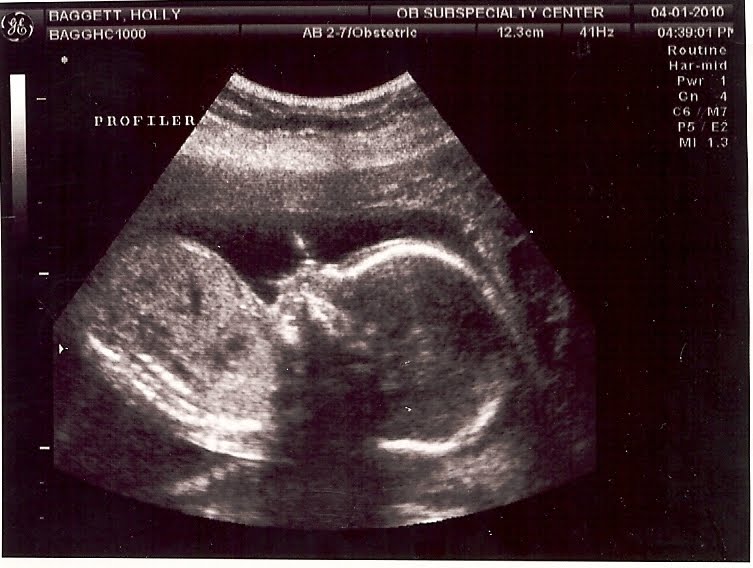 Baggett Basics: Ultrasound - 20 weeks