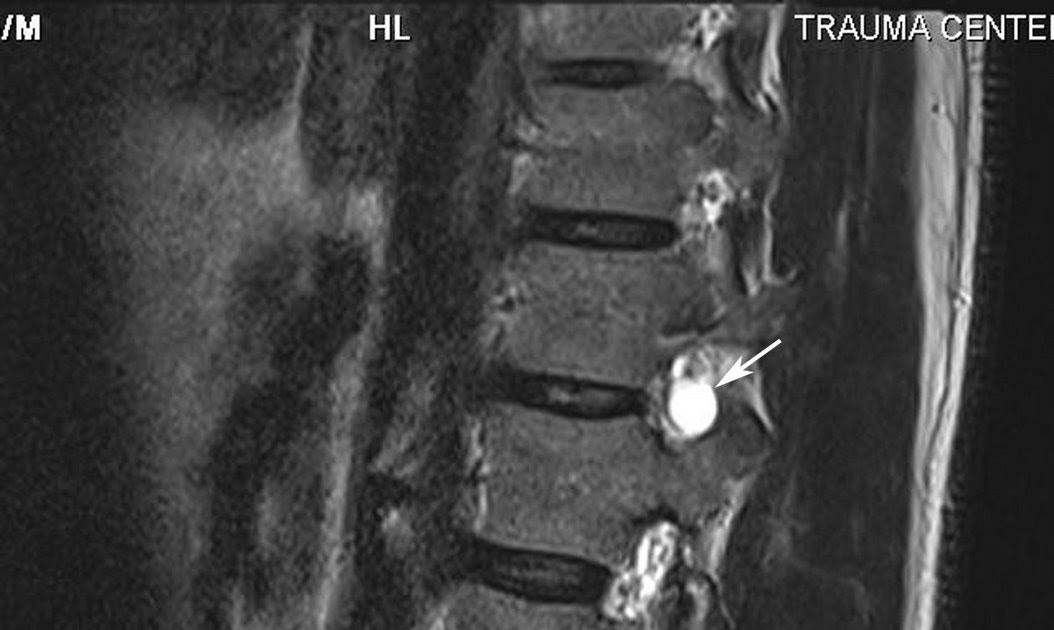Radiodiagnosis - Imaging is Amazing-Interesting cases: Tarlov Cyst