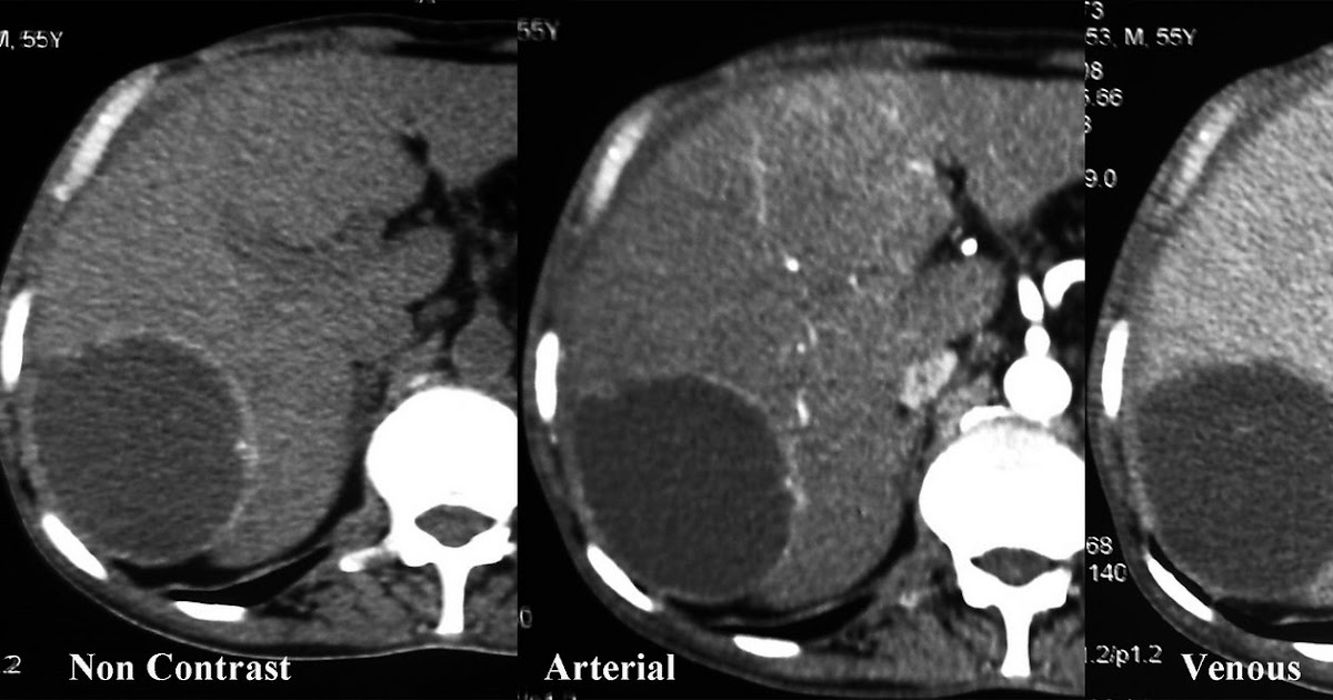 Radiodiagnosis Imaging Is Amazing Interesting Cases Hydatid Cyst Of Liver