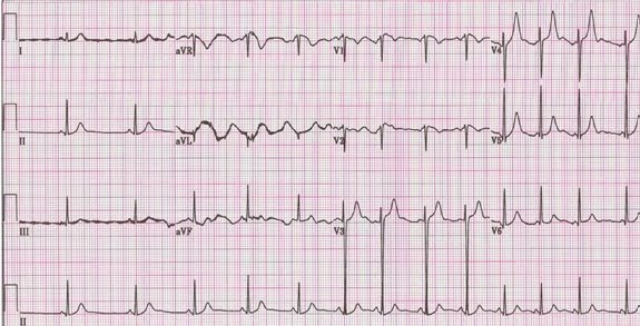 Family Practice Pearls: Early MI and peaked T-waves