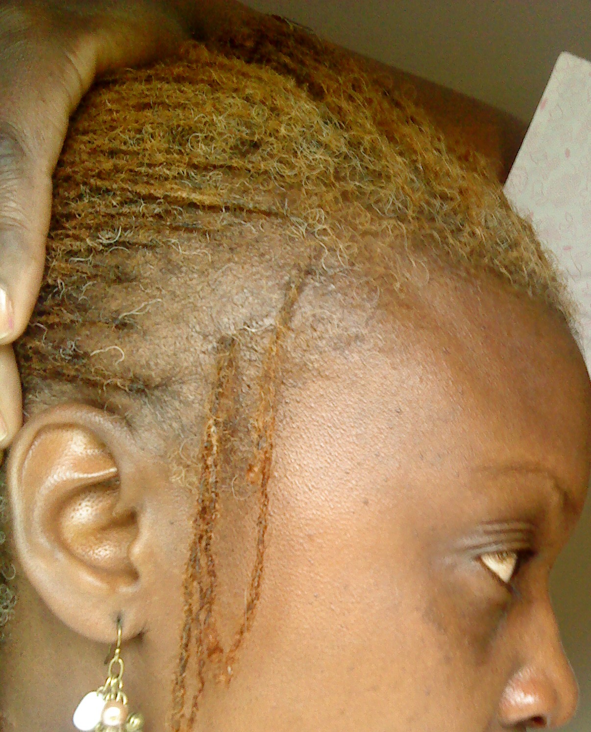 LocksRevisited: THIN HAIR ON RIGHT TEMPLE ONLY!!!