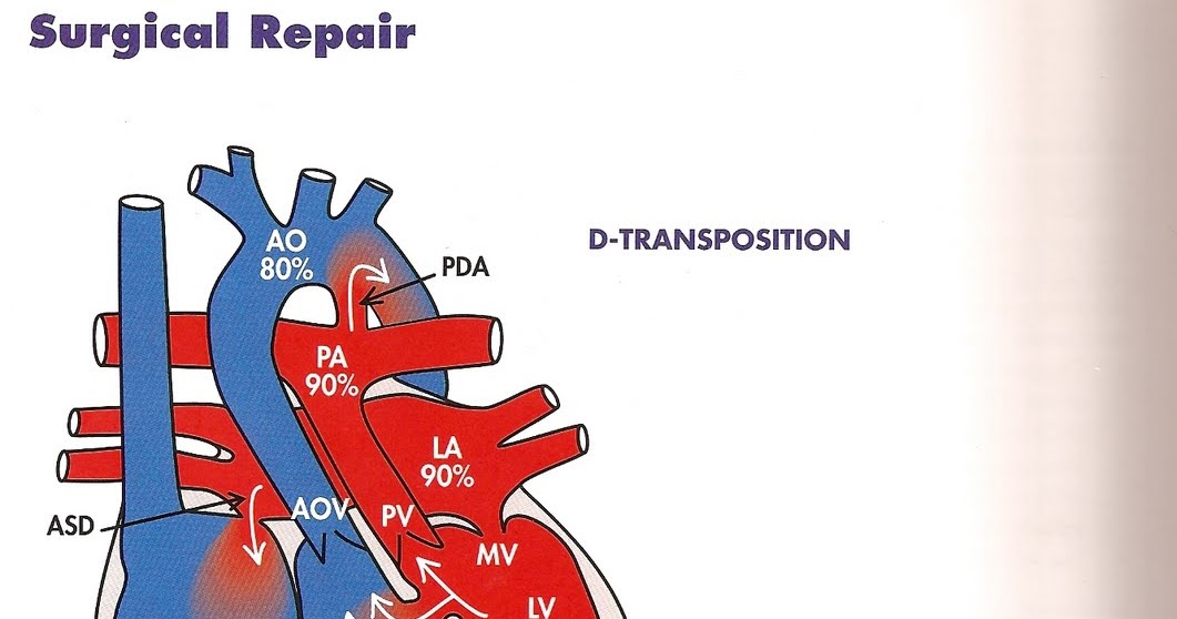Heart defects, for everyone: D-Transposition of the great Arteries ...