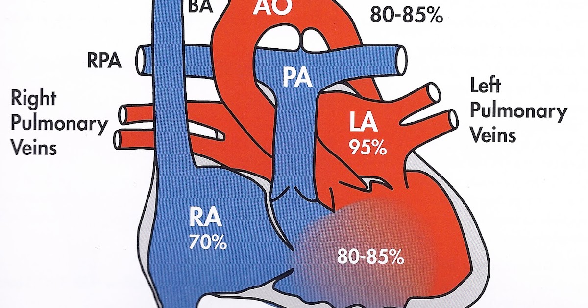 Heart defects, for everyone: Univentricular Heart (Single Ventricle ...