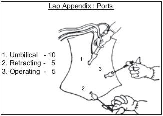 Endoscopia Ginecologica: Apendicectomia laparoscopica