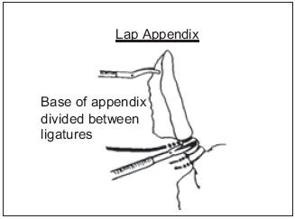Endoscopia Ginecologica: Apendicectomia laparoscopica