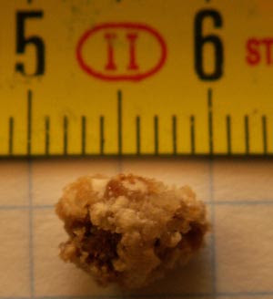 SCIENCE 10 AND BIOLOGY 12: Nephrons and Kidney Stones