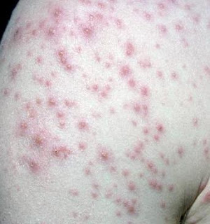 Resources for General Practice: Viral Rashes