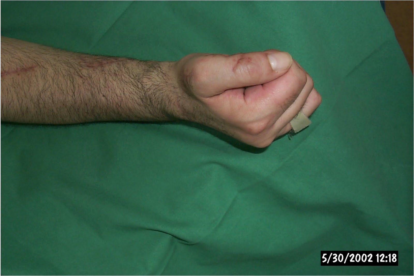 Reconstructive Hand Surgery In Tetraplegia: Surgery