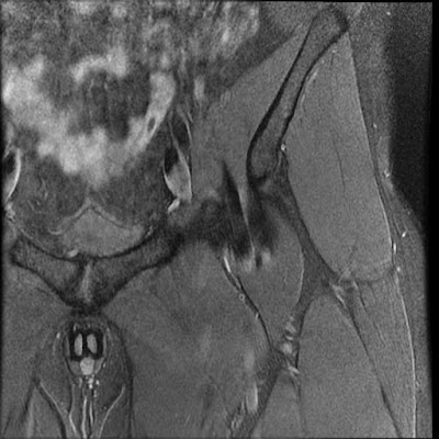 Radiology Cases: Snapping Hip Syndrome