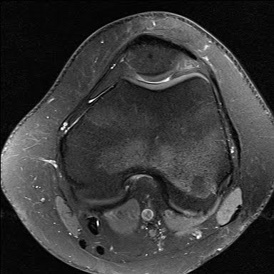 Radiology Cases: Patellar Tendon-Lateral Femoral Condyle Friction Syndrome