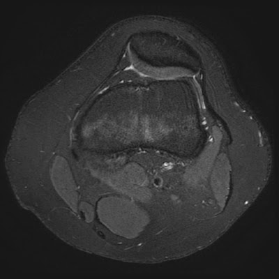 Radiology Cases: Lateral Patella Subluxation, Patella Tilt, Shallow ...