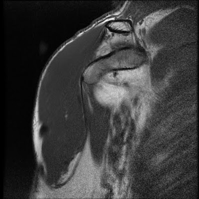 Radiology Cases: Subcoracoid Impingement and Subscapularis Tear