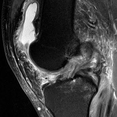 Radiology Cases: Deep Lateral Sulcus Sign (Deep Femoral Notch Sign) and ...