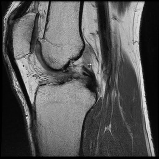 Radiology Cases Anterior Tibial Translation Sign In Acl Tear