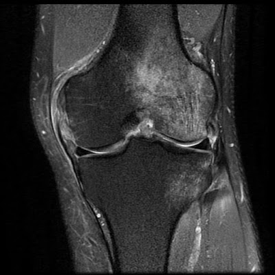 Radiology Cases: ACL Rupture and Grade III MCL Tear
