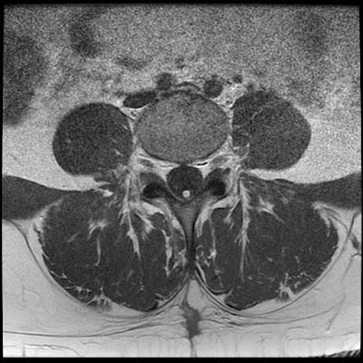 Filum Terminale Lipoma