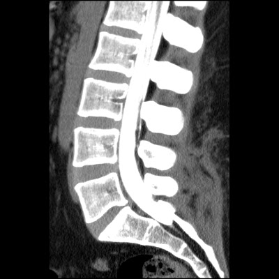 Radiology Cases: Filum Terminale Lipoma