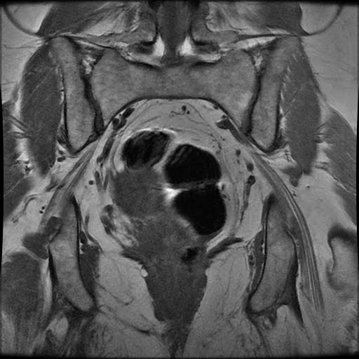 Radiology Cases: Lumbar Plexopathy