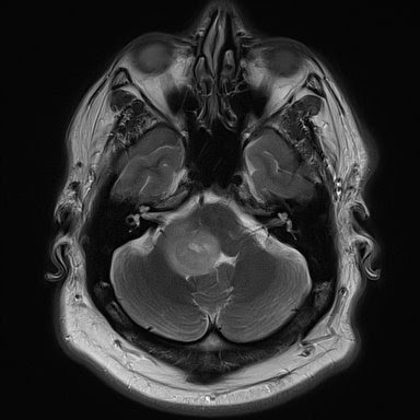 Radiology Cases: Brainstem Glioma, subtle on CT, easy on MRI