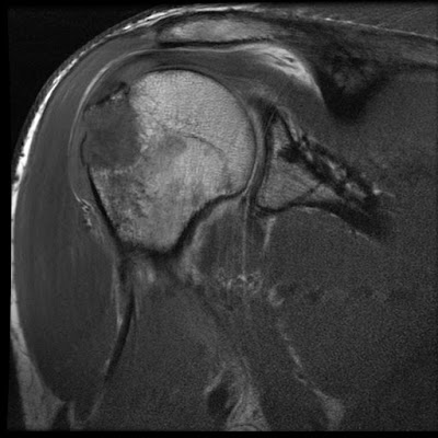 Radiology Cases: HAGL Lesion, Greater Tuberosity Fracture and SS Tear
