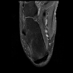 Radiology Cases: Haglund's Syndrome