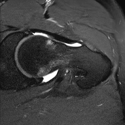 Radiology Cases: Femero-acetabular impingement (Cam type)
