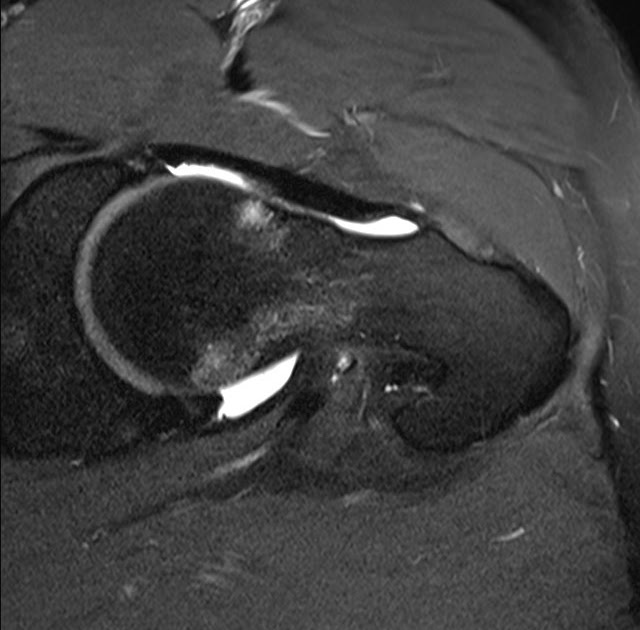 Cam Type Femoroacetabular Impingement Radiology at Eileen Towner blog