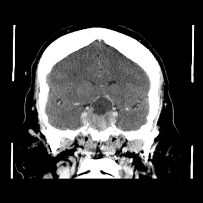 Radiology Cases: Macroadenoma