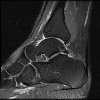 Radiology Cases: Os Trigonum Syndrome