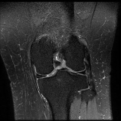 Radiology Cases: Meniscal Parrot Beak Tear