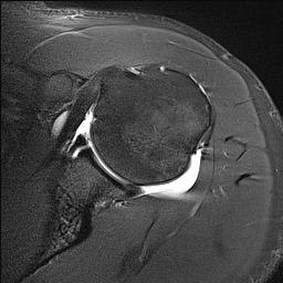 Radiology Cases: Sublabral Recess