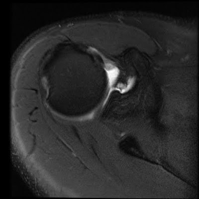 Radiology Cases: SLAP V