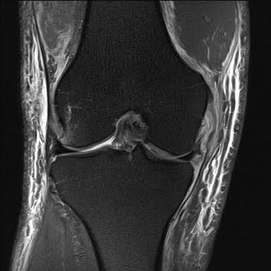 Radiology Cases: Grade III MCL Tear