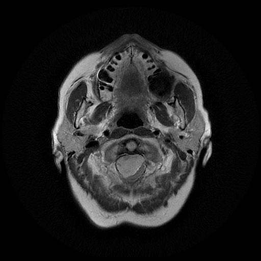 Radiology Cases: CCJ Meningioma