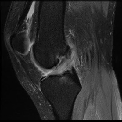 Radiology Cases: ACL Interstitial Injury
