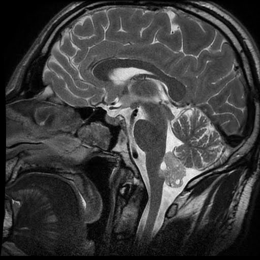Radiology Cases: Subependymoma