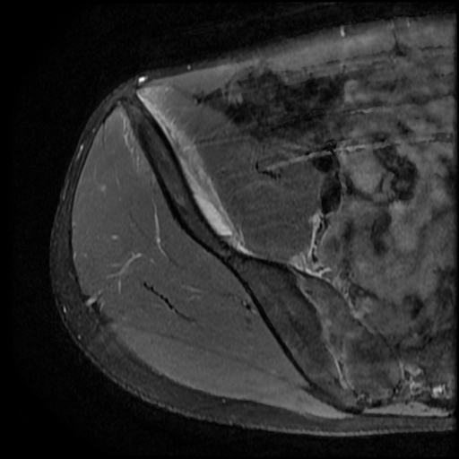 Radiology Cases: Rectus Femoris Partial Tear and Sub-Iliacus Haemorrhage