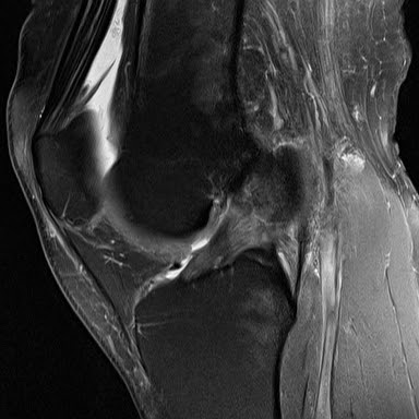 Radiology Cases: Partial ACL Tear