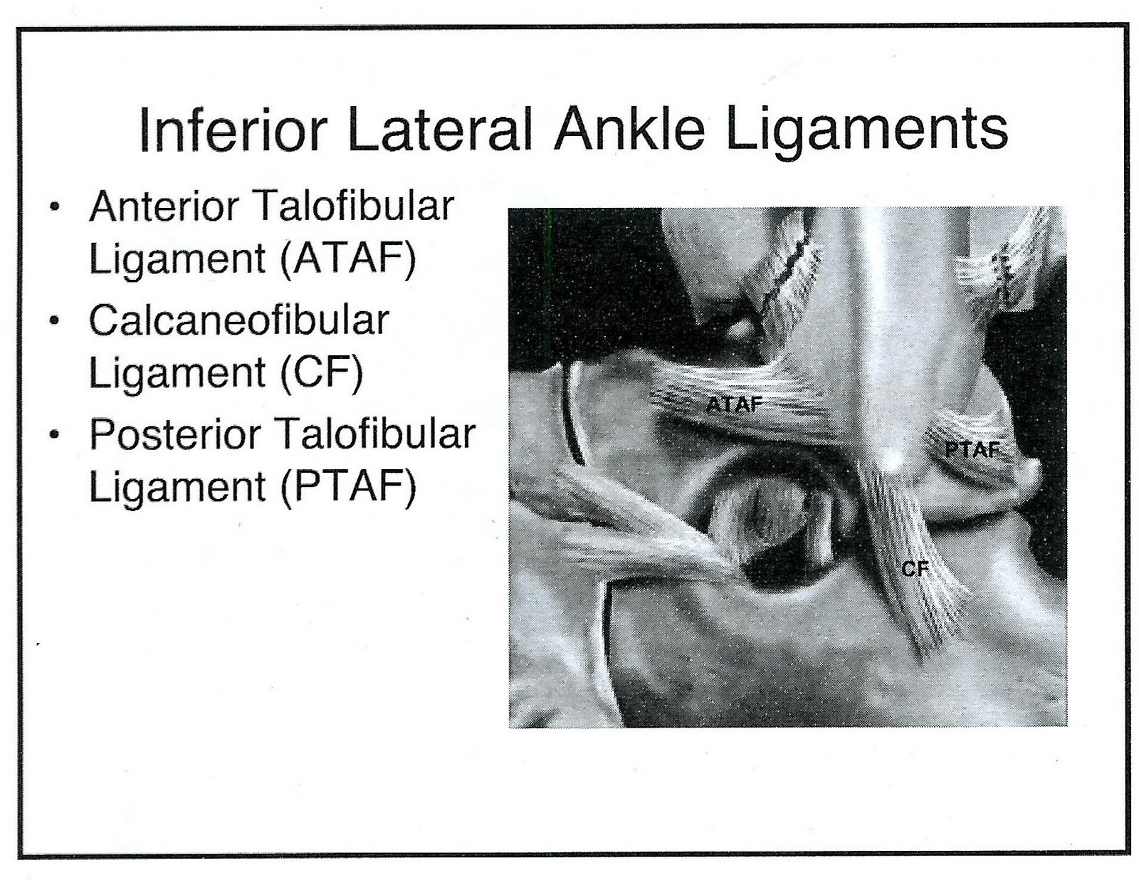 Radiology Cases: Lateral and Medial Ankle Ligaments