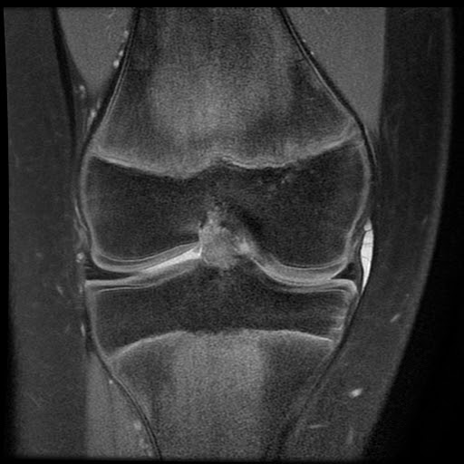 Radiology Cases: Voshell's Bursitis